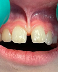 Tongue Tie And Lip Tie Las Vegas Childrens Dentist Your Pediatric