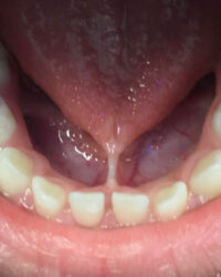 Tongue Tie And Lip Tie Las Vegas Childrens Dentist Your Pediatric